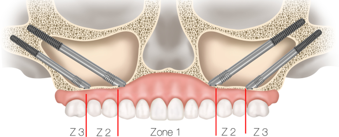 Zygomatic Implants – Proclinix Dental Implant Centre